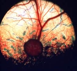 Lecture Retinal Disorders Flashcards Quizlet