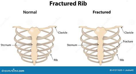Rib Cage With A Fracture Stock Vector Image 41211635