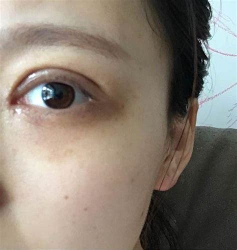 眼角痛一眨眼就痛疼痛大山谷图库