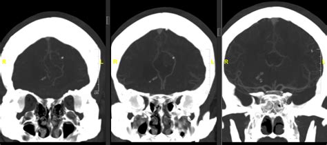 Epidermoid Intracranial