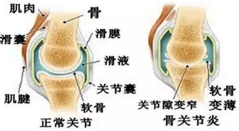 【健康科普】且行且珍“膝”，你的关节还好吗？锻炼潘童风湿