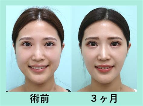 バッカルファットなし！ 脂肪吸引＋糸リフトでシャープな小顔に Womクリニック銀座