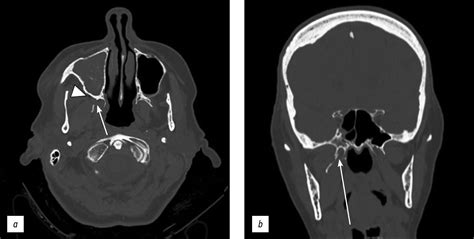 Pterygoid Plate Radiograph
