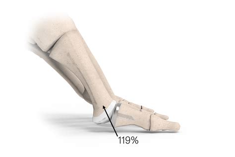 A Proven Hallux Rigidus Solution The Biopro First Mpj Hemi Implant