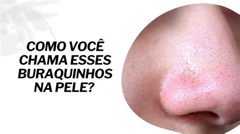 COMO VOCÊ CHAMA ESSES BURAQUINHOS NA PELE YouTube