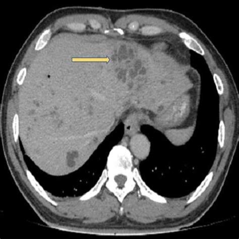 Arrows Showing Extra Biliary Contrast Suggestive Of Hepatic Abscesses Download Scientific