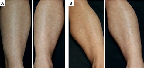 Figure 1 From Treatment Of Idiopathic Guttate Hypomelanosis With Er Yag