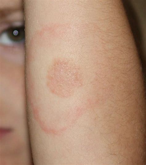 Skin Fungal Infection Know About Disease Treatments Cost Skinaa