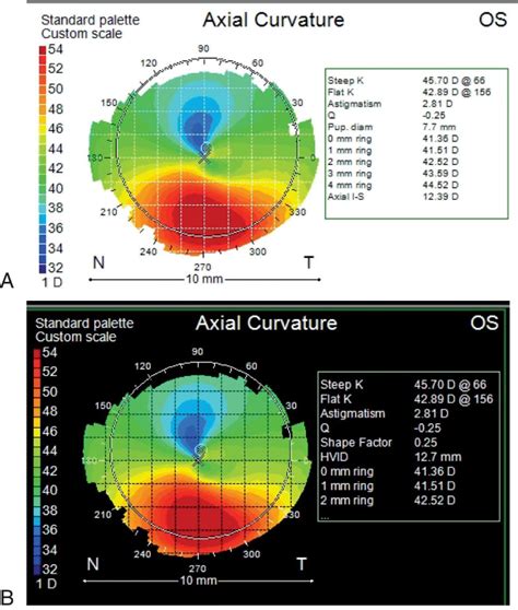 Keratoconus Classification Systems Ento Key