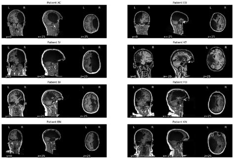 Anatomical MRI Images Illustrating The Intact And Resected Portions Of Download Scientific