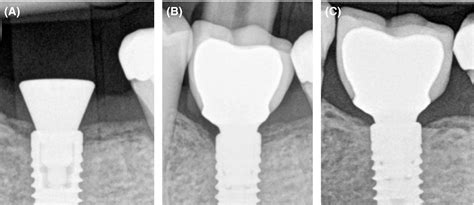 Early Crestal Bone Loss Is It Really Loss Puisys 2019 Clinical