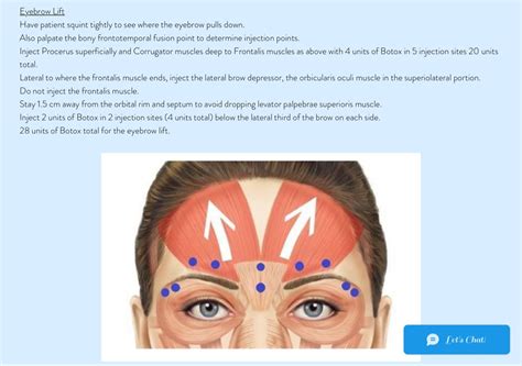 Levator Palpebrae Superioris Botox