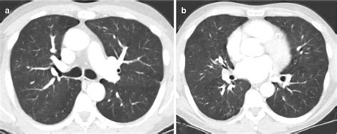 Diffuse Alveolar Hemorrhage Anesthesia Key