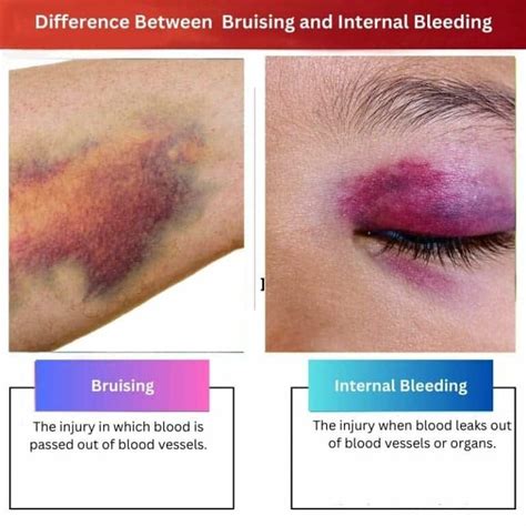 Bruising Vs Internal Bleeding Difference And Comparison