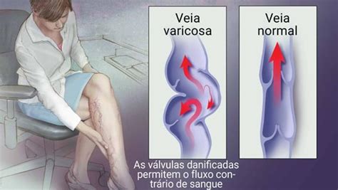 Como tratar as varizes sintomas e complicações