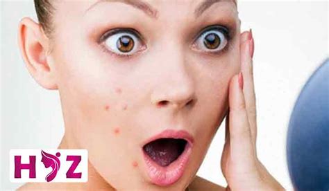 درمان قطعی جوش صورت درمان جوش های چرکی دردناک های زیبا