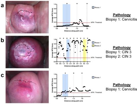 Development Of A Multimodal Mobile Colposcope For Real Time Cervical