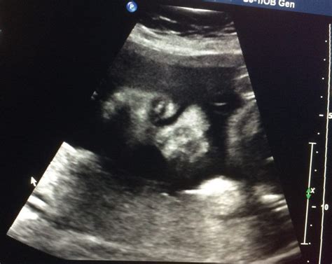 20 Week Ultrasound Down Syndrome Captions Week