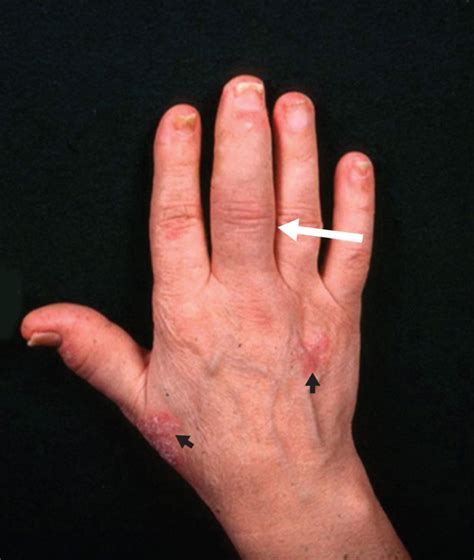 Diagnosis And Management Of Psoriatic Arthropathy In Primary Care