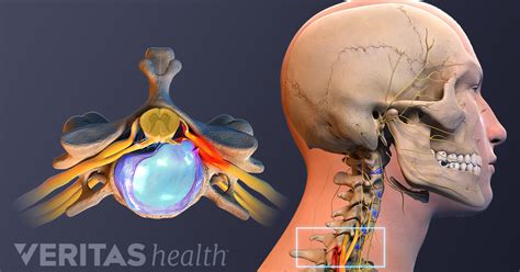 Cervical Herniated Disc Causes And Diagnosis
