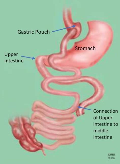 Gastric Bypass Pin On My 600 Lb Life Tlc