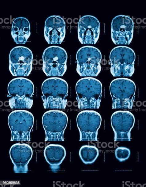 자기 공명 영상 스캔 뇌 코로나 보기 Mri 스캔에 대한 스톡 사진 및 기타 이미지 Mri 스캔 Cat 스캔 뇌하수체
