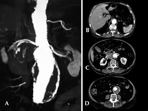 Abdominal Computed Tomography Saccular And Fusiform Aneurysm Of The