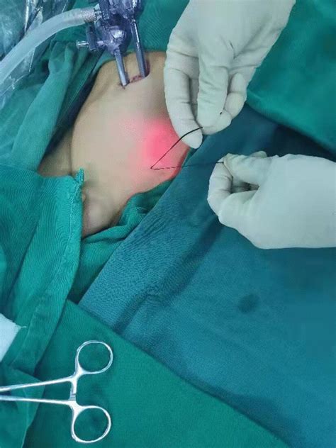 The Second Thread Loop Had Been Pulled Out And Circled The Internal Download Scientific Diagram