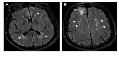 Multiple Periventricular And Deep White Matter Hyperintensities