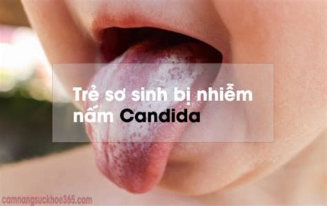 Các triệu chứng nấm candida bạn luôn phải ghi nhớ thật kĩ