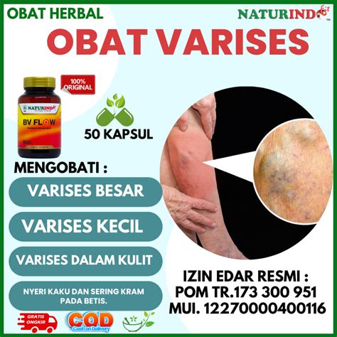 Jual Obat Varises Paling Ampuh Herbal Otot Kaki Bengkak Farises Di