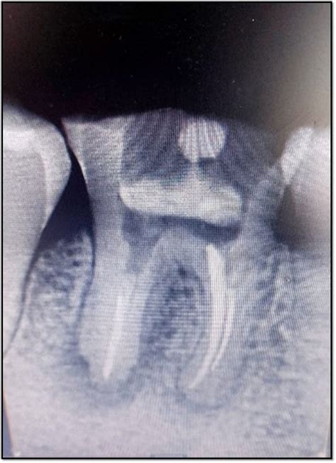 Prosthodontic Rehabilitation Of A Hemisectedmolar A Case Report Guident
