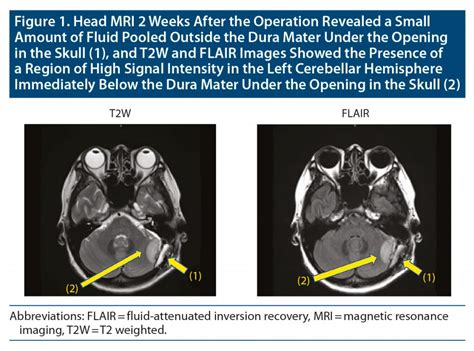 Auditory Hallucinations After Microvascular Decompression For Intractable Trigeminal Neuralgia
