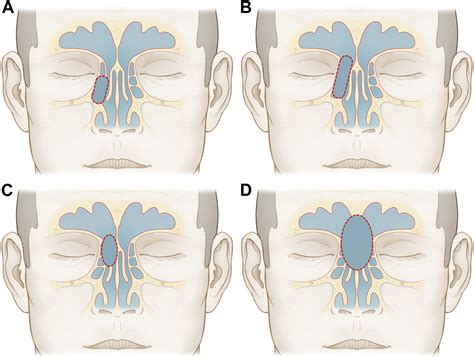 Endoscopic Approaches To The Frontal Sinus Otolaryngologic Clinics Of