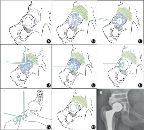 Ah The Manual Sketch Of Critical Procedures Of The Ibg Technique