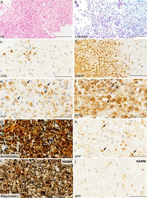 Histology Of Biopsied Ms Lesions He Shows Cellular White Matter
