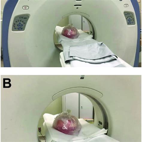 Surgical Characteristics In Bilateral Lung Transplantation Download