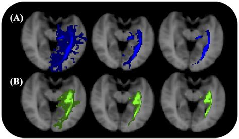 Left Optic Radiation Sdis For A Single Subject The Or Of The Same