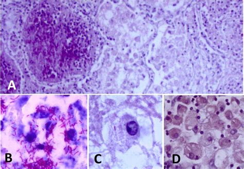 图示评论性回顾：继发性肺结核的病理
