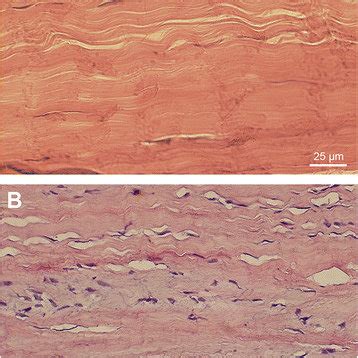 Histological Differences Between Normal And Tendinosis Tendon The