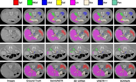 Scanext Enhancing 3d Medical Image Segmentation With Dual Attention