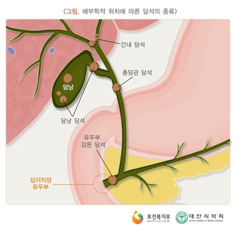 담낭 담석 담석의 증상 담석 산통담도성 통증 Biliary Colic이란 네이버 블로그