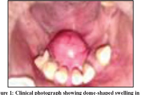Figure 1 From Non Syndromic Solitary Neurofibroma In Floor Of The Mouth