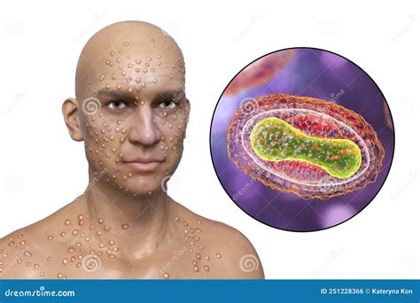 A Man With Smallpox Disease And Close Up View Of Variola Virus A Virus