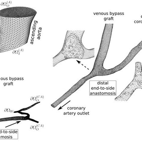 Individual Graft Unstructured Computational Mesh And Relevant