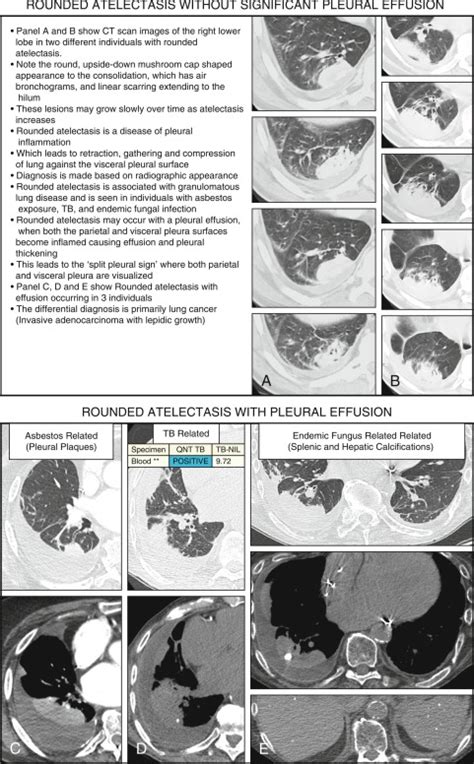 Cough Syncope Thoracic Key