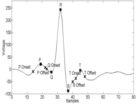 Figure 1 From A System Of Biometric Authentication Based On Ecg Signal Segmentation Semantic