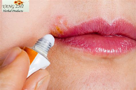 Chinese Medicine For Cold Sores