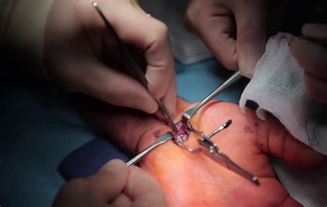 Hình ảnh mổ hội chứng ống cổ tay Tìm hiểu thông tin chi tiết và cách