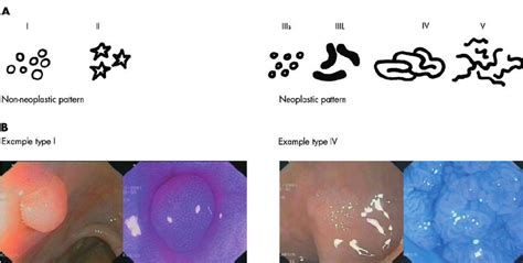 Pit Pattern Classification According To Kudo And Colleagues 16 The Download Scientific